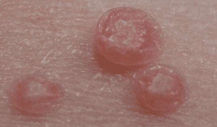 Molluscum Contagiosum Pictures Symptoms Causes Treatment HubPages