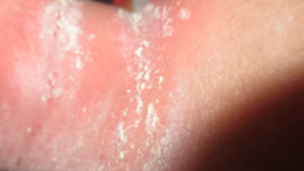 Lamictal Rash Symptoms Treatment Images Youmemindbody