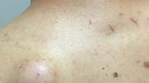 Definitive Guide to Pilonidal Cysts: My Experience - Patient's Lounge