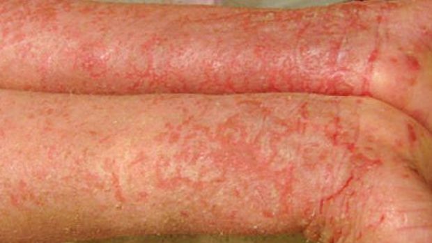 Managing Skin Health - Patient's Lounge - Patient Medical Experiences