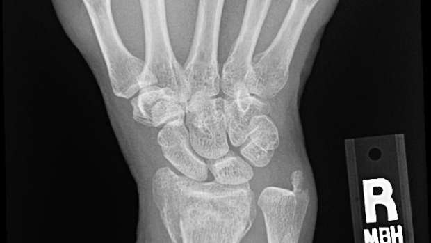 Hand & Wrist Injuries - Patient's Lounge