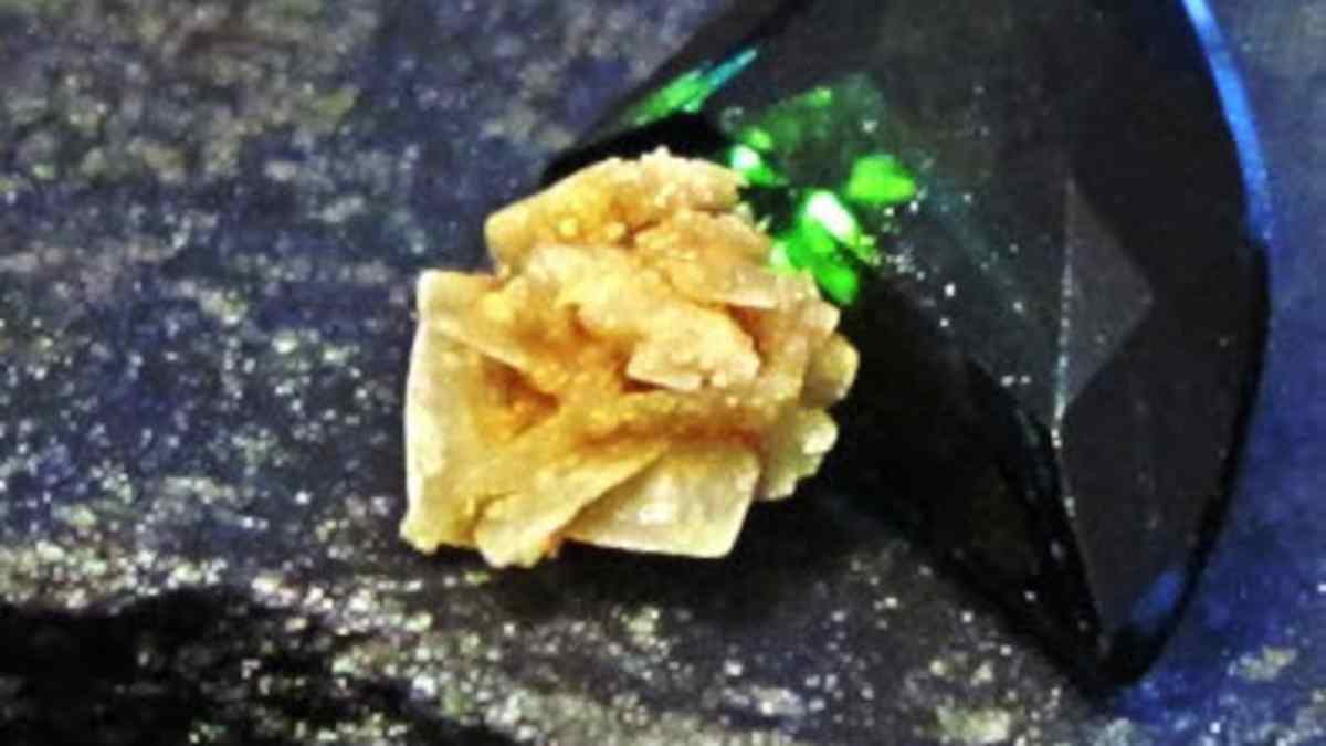 nephrolithiasis nice