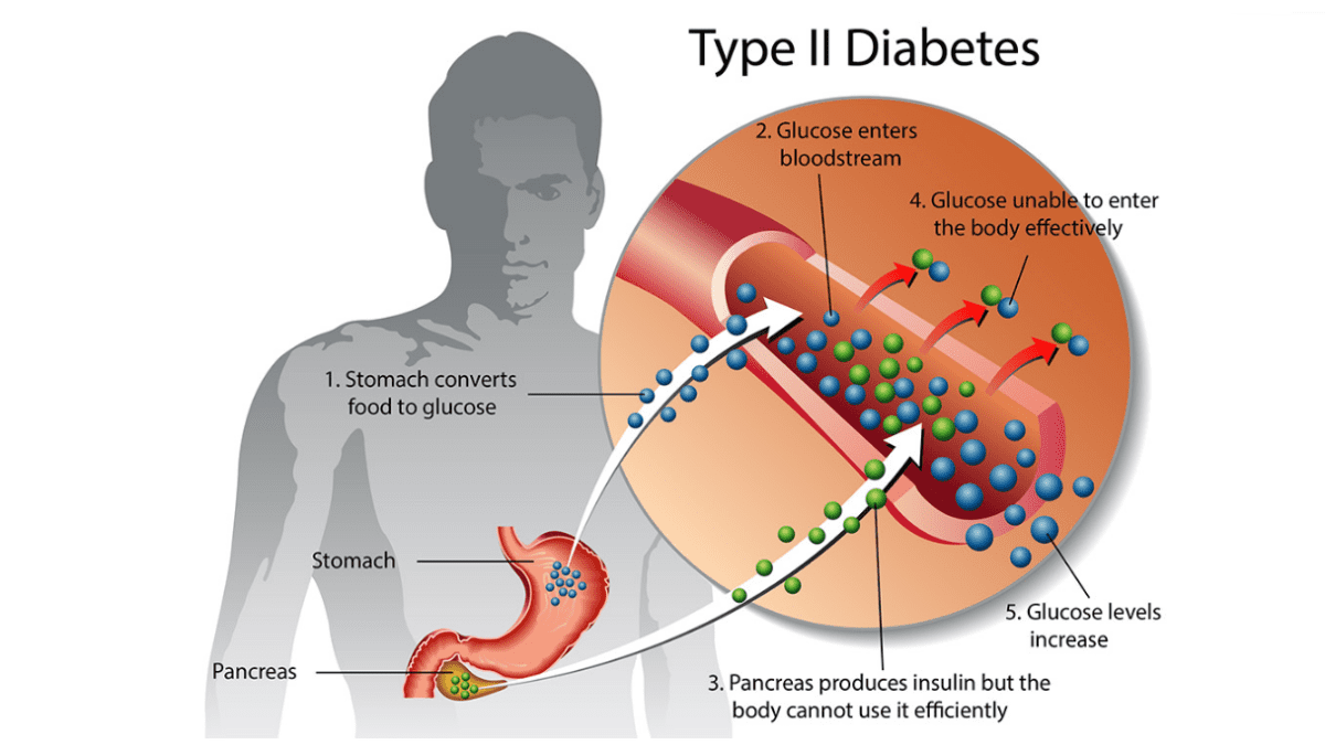 diabetes   type 2