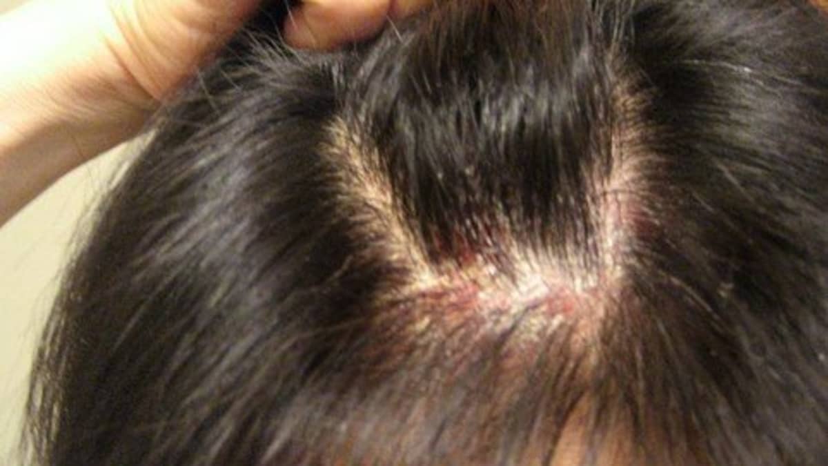 Itchy scalp hair loss store