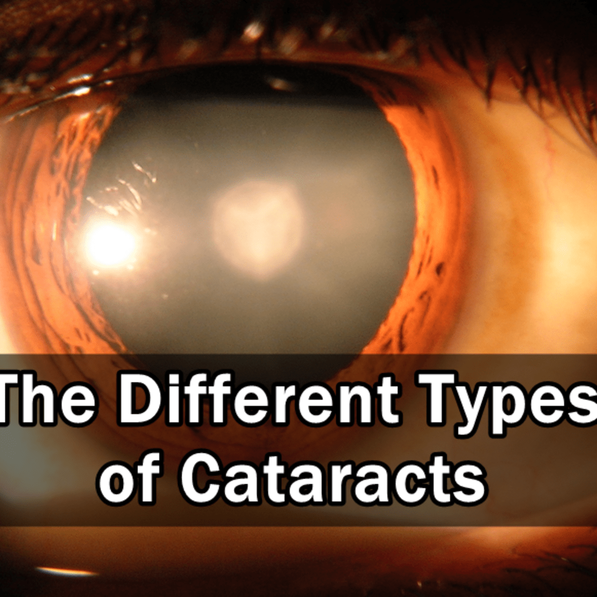 cataract different types