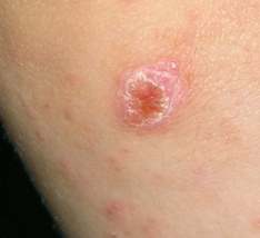 Spider Bite Pictures, Symptoms, and Treatments - HubPages
