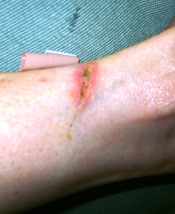 Pseudomonas Aeruginosa Infection: My Story - Patient's Lounge