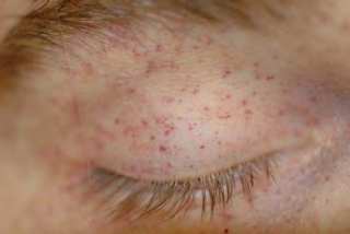 Petechiae - Symphtoms of hemorhagic spots - HubPages