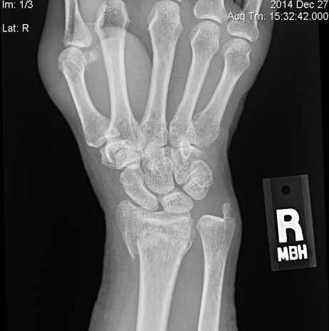 DIY Physical Therapy Ideas for My Broken Wrist - HubPages