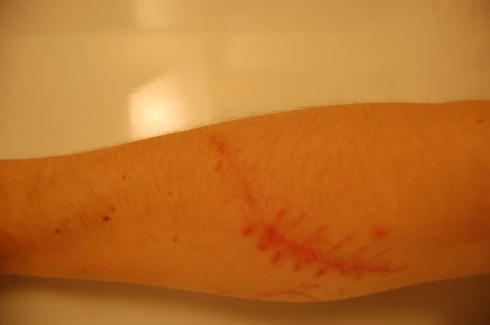 My Experience With Surgical Excision and Laser Tattoo Removal ...