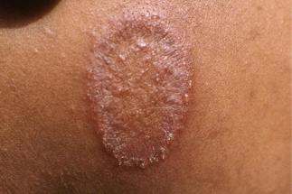 Bullseye Rashes: Ringworm and Lyme Disease Differences and My Diagnosis ...