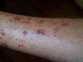 Causes of Senile Purpura - Information and Symptoms of Senile Bleeding ...