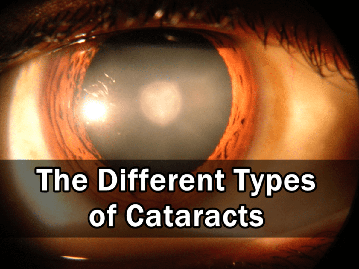 cataracts 3 types