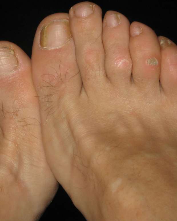 How to Get Rid of Canker Sores: 10 Proven Home Remedies - RemedyGrove