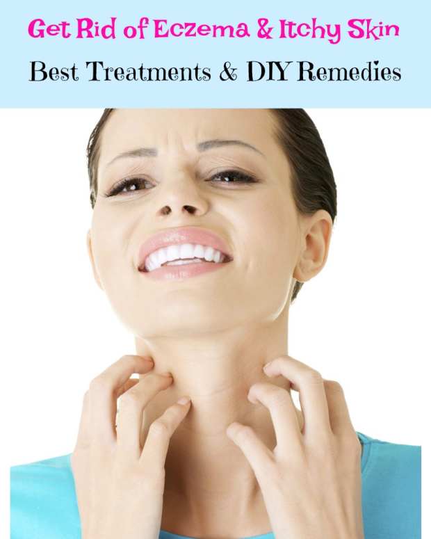 How I Cured My Eczema Naturally - RemedyGrove