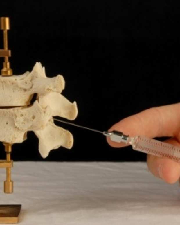 Post-Spinal Anesthesia Side Effects - HealthProAdvice