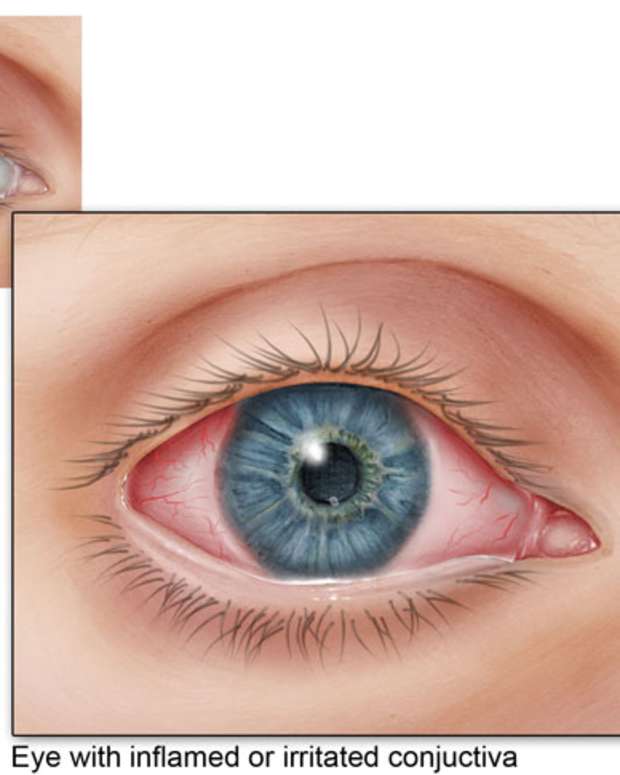 Pink Eye (Conjunctivitis) Relief With Castor Oil - RemedyGrove ...