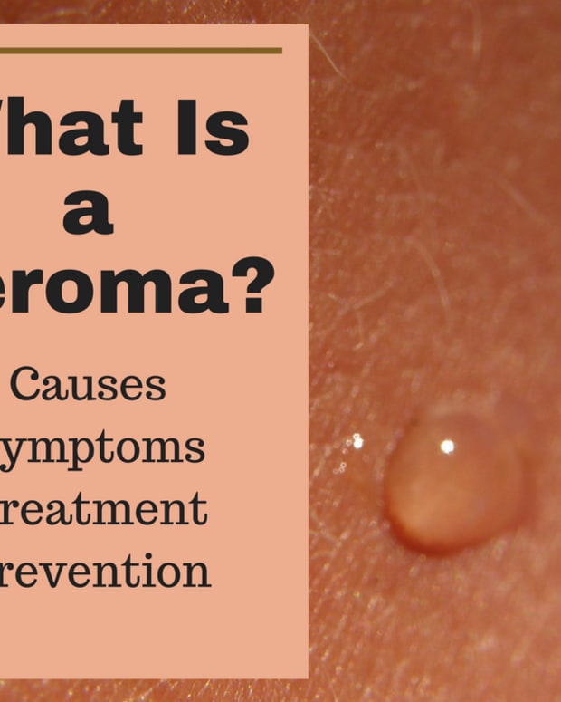 Parotitis - Symptoms, Causes, Treatment, and Pictures - YouMeMindBody