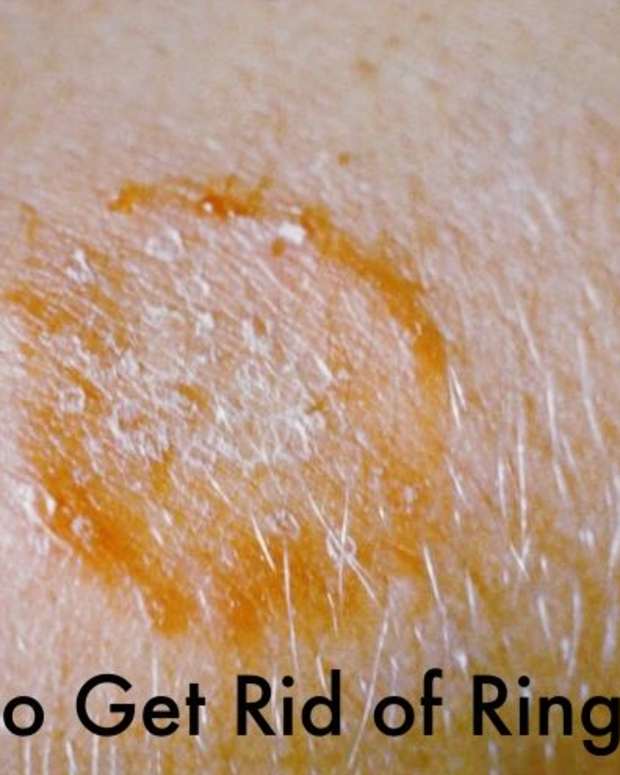 My Atypical Scabies Symptoms: Unusual Signs of Mites That Doctors Don't ...