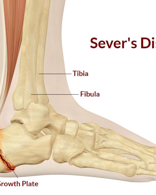 A Severed Flexor Tendon in the Pinky Finger: My Story - Patient's ...