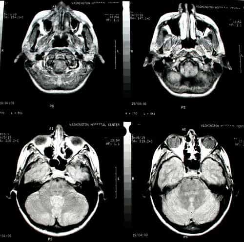 Male and Female Brains: Similarities and Differences - HubPages