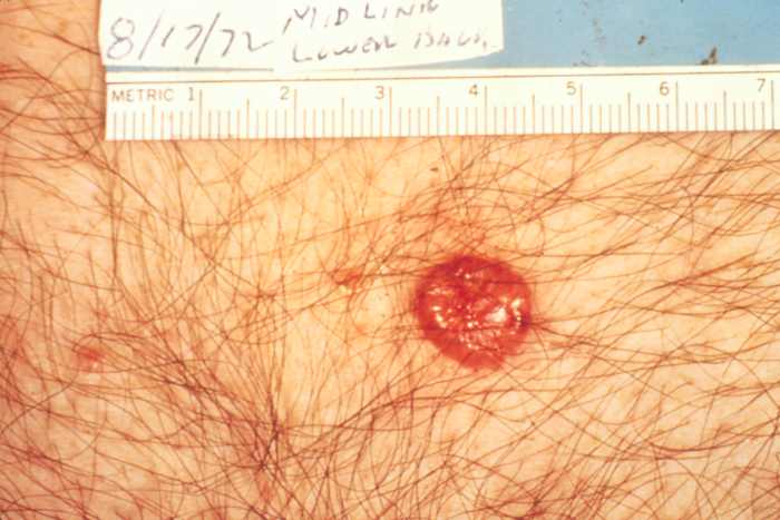 How I Discovered My Basal Cell Carcinoma (Skin Cancer) - Patient's Lounge