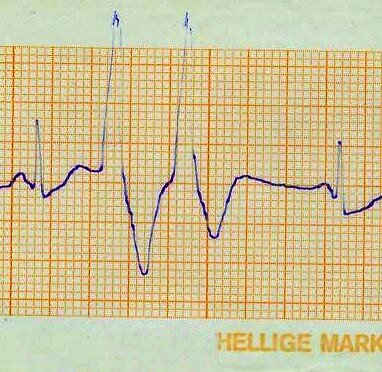 What Is a PVC (Premature Ventricular Contraction)? - HealthProAdvice