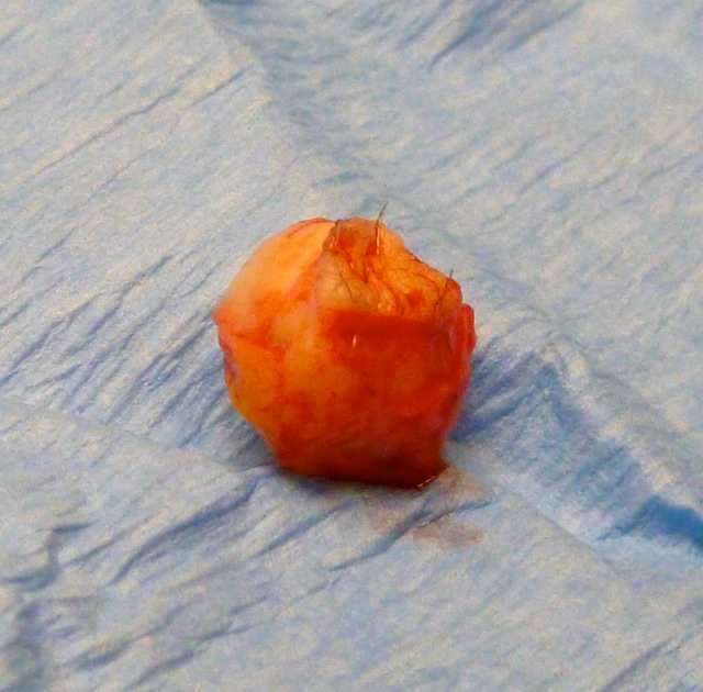 This Is What My Cyst Looked Like - Patient's Lounge