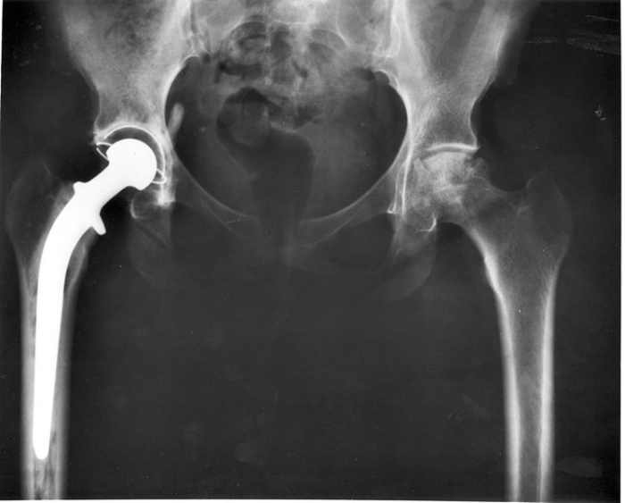 What I Learned About Total Hip Replacement, Avascular Necrosis, and ...