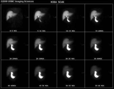 My Experience Undergoing a HIDA Scan - Patient's Lounge