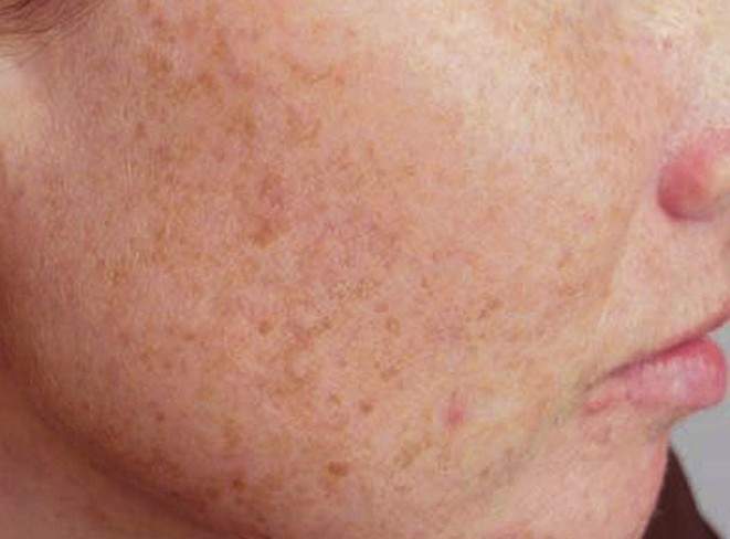 Liver Spots: Causes, Treatments, and Removal Options - YouMeMindBody