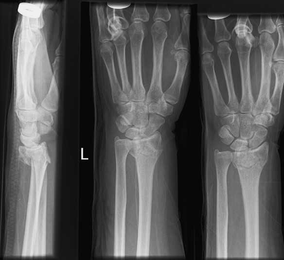 Colles’ Fracture - Pictures, Treatment, Healing Time, Surgery, Symptoms ...
