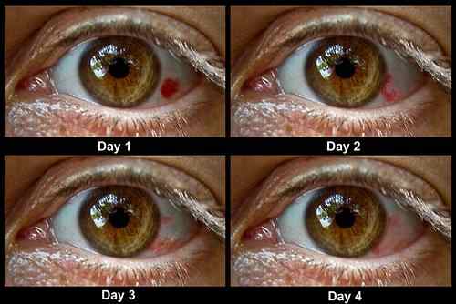 What Causes Broken or Burst Blood Vessels in the Eyes? - HubPages