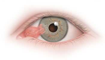 What Is Surfer's Eye? Pterygium and Pinguecula Explained - HubPages