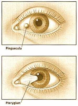 What Is Surfer's Eye? Pterygium and Pinguecula Explained - HubPages