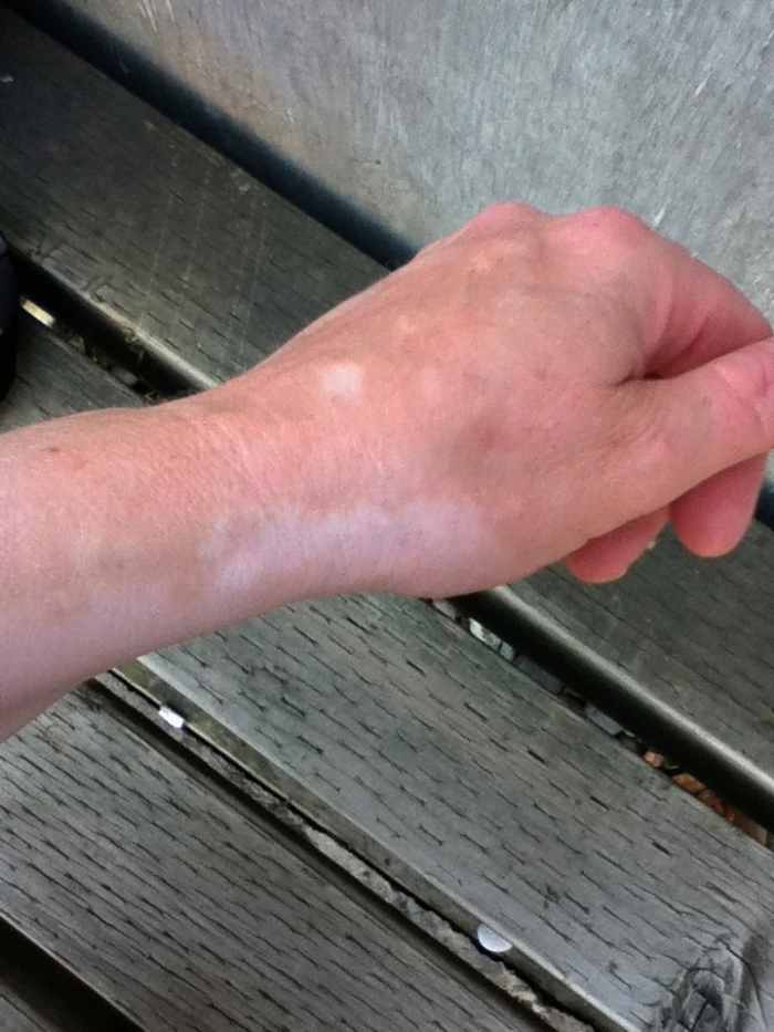 Vitiligo Facts: Skin Pigment Loss and Possible Treatments - HubPages