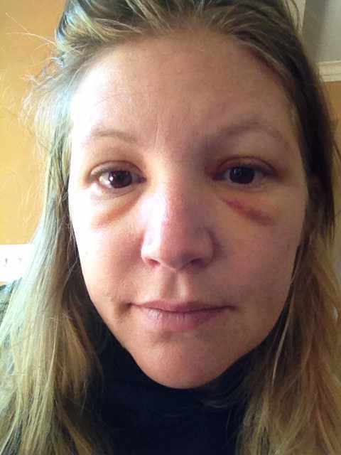 My Experience of a Bee Sting Near My Eye (With Photo Progression ...