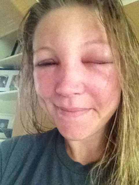 My Experience of a Bee Sting Near My Eye (With Photo Progression ...