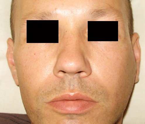 Parotitis - Symptoms, Causes, Treatment, and Pictures - HubPages