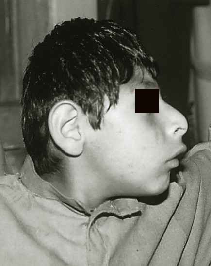 Guide to Microcephaly: Causes, Symptoms, Treatment Methods, Life ...