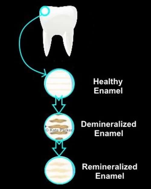 Can Cavities Be Healed? - HubPages