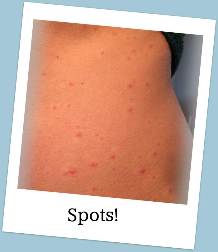 Adult Chicken Pox: 7 Symptoms I Experienced - HubPages
