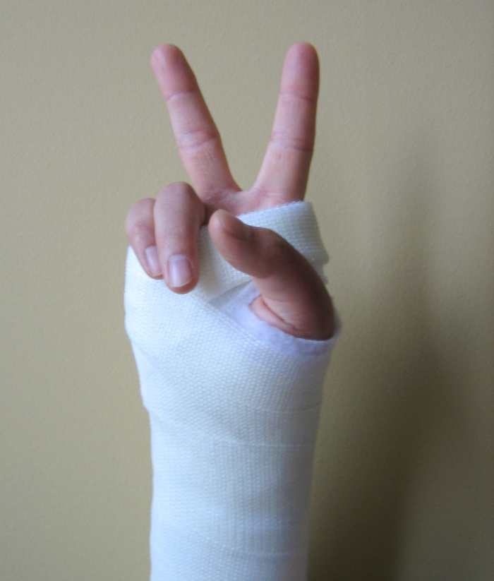 Recovering From Two Broken Wrists: My Story - Patient's Lounge