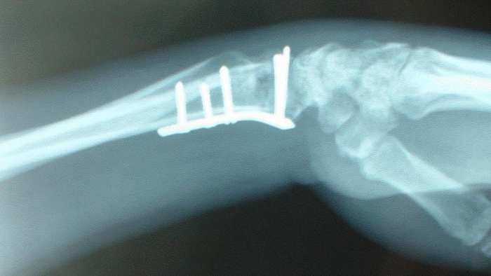 Recovering From Two Broken Wrists: My Story - Patient's Lounge