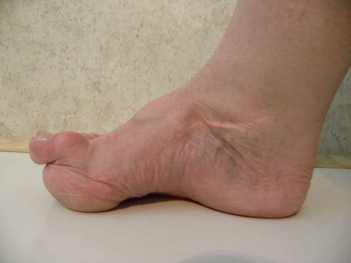 I Am a Polio Survivor - HubPages