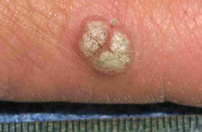 My Experience With Warts: Causes, Home Treatments, and Pictures - HubPages