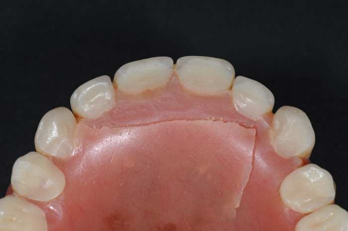 What to Expect When Getting Dentures for the First Time: My Experience ...