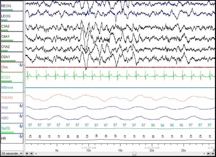My Sleep Study Experience: Overnight Test for Sleep Apnea - HubPages