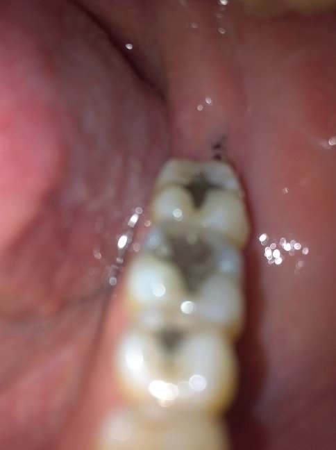 What It’s Like to Have Your Wisdom Teeth Removed - Patient's Lounge