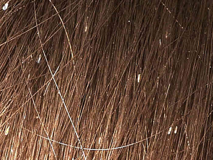 A Step-By-Step Guide to Naturally Getting Rid of Lice at Home - RemedyGrove